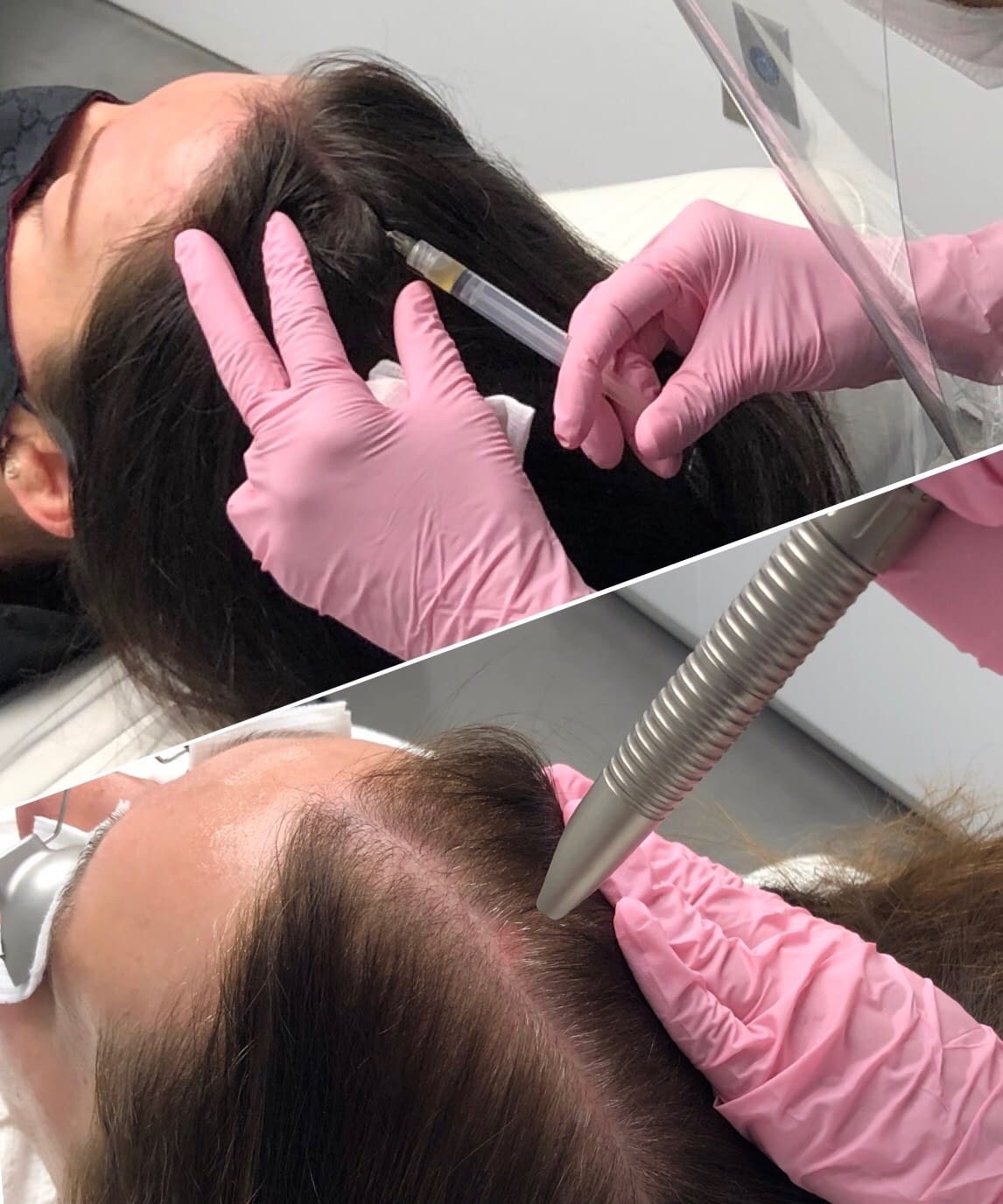 PRP + Laser Hair Rejuvenation Program - Skin Method