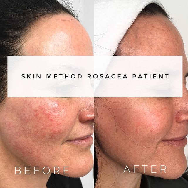Rosacea Key Ingredients To Treat And Control Skin Method